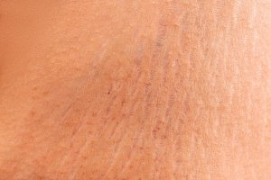 Heb jij last van striae? Met deze simpele methode kun je het verminderen