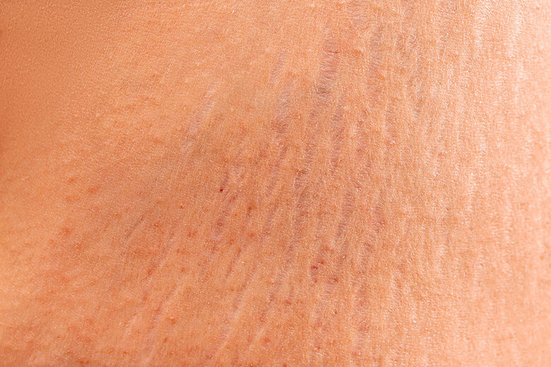 Heb jij last van striae? Met deze simpele methode kun je het verminderen